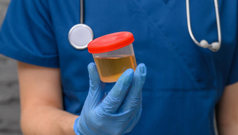 Johns Hopkins researchers develop urine-based prostate cancer test