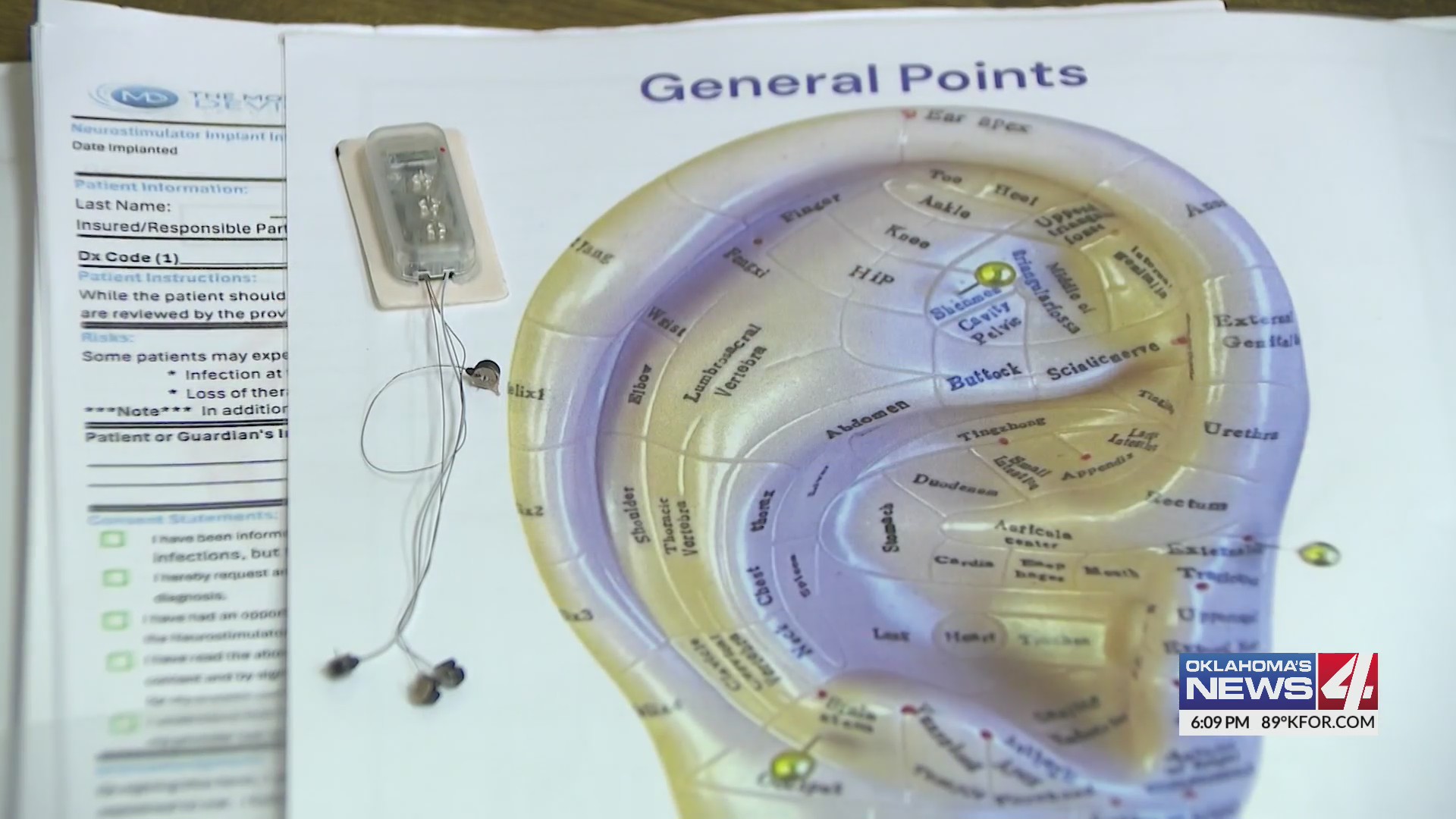 Nerve stimulator offers drug-free pain relief