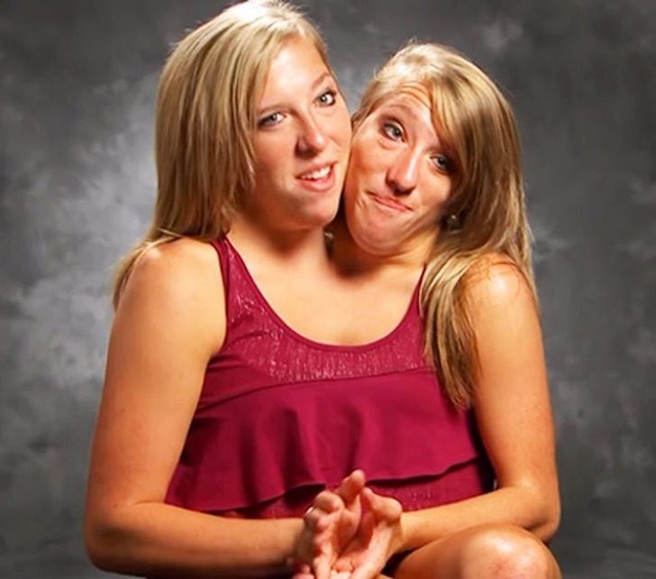 “I’m Just Confused!” One of the Famous Conjoined Twins Got Married ...