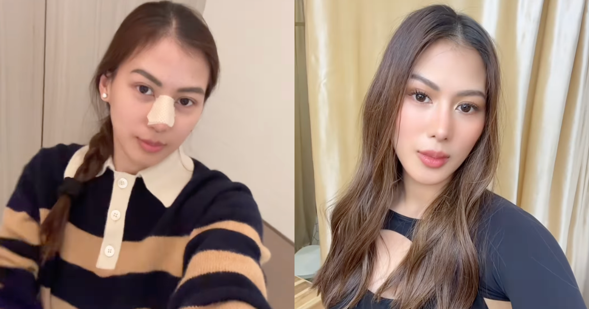 Alex Gonzaga shares she removed her nose implant