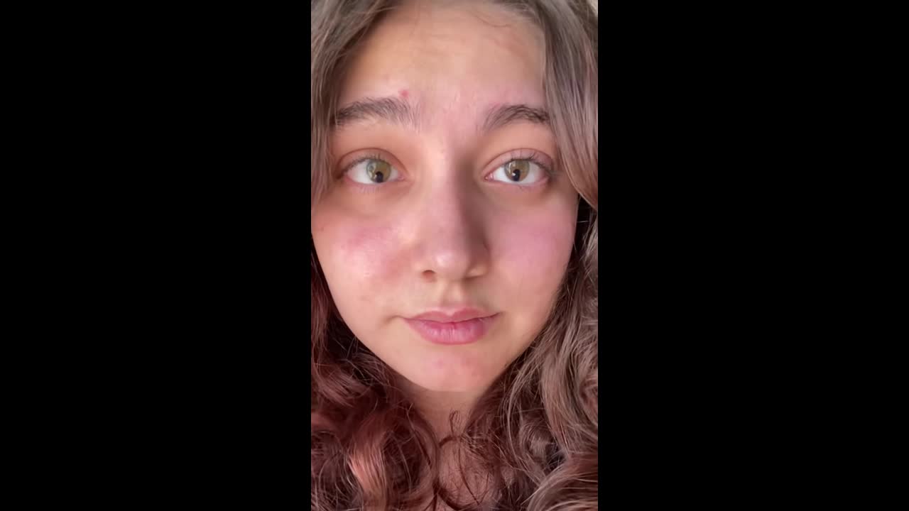 Woman proudly shows her Coloboma eyes on camera