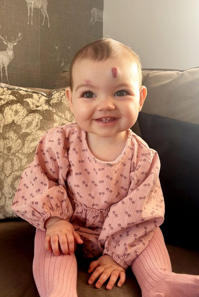 “Strangers mistook my child’s strawberry birthmark for a bumped head”