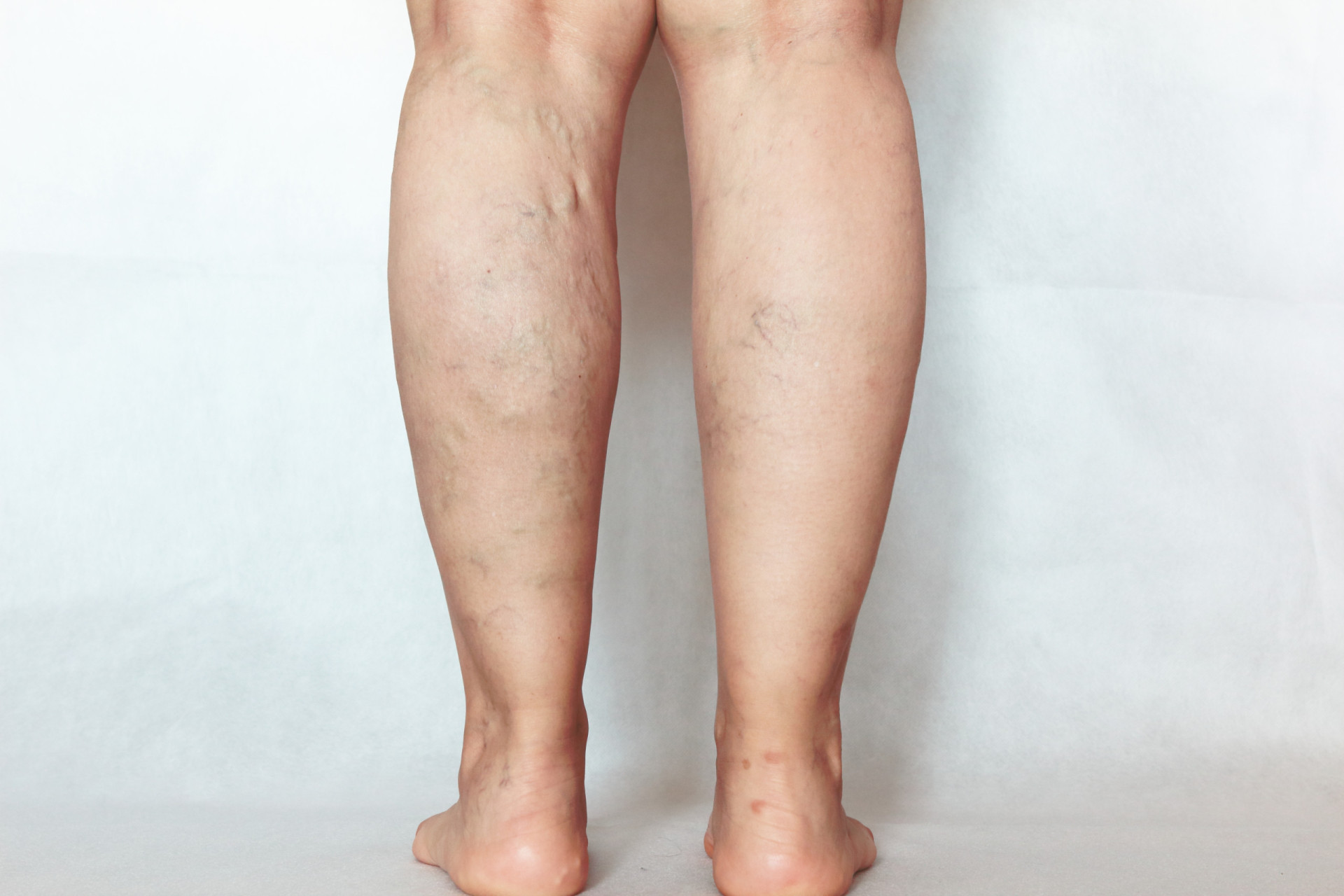 Deep vein thrombosis: know and reduce the risk