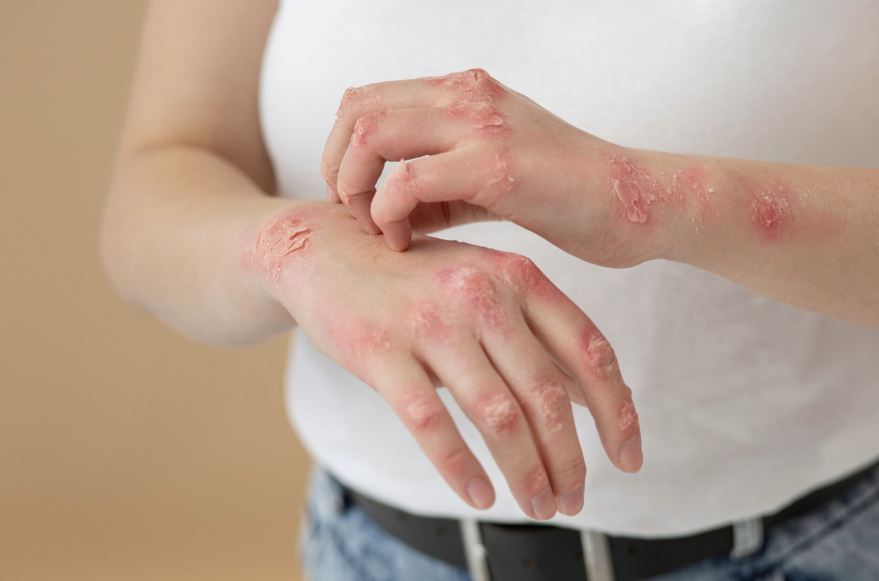 Lupus, căn bệnh tự miễn âm thầm nhưng nguy hiểm