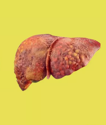 Fatty liver will be cured in just 28 days, just follow the 7 surefire ...