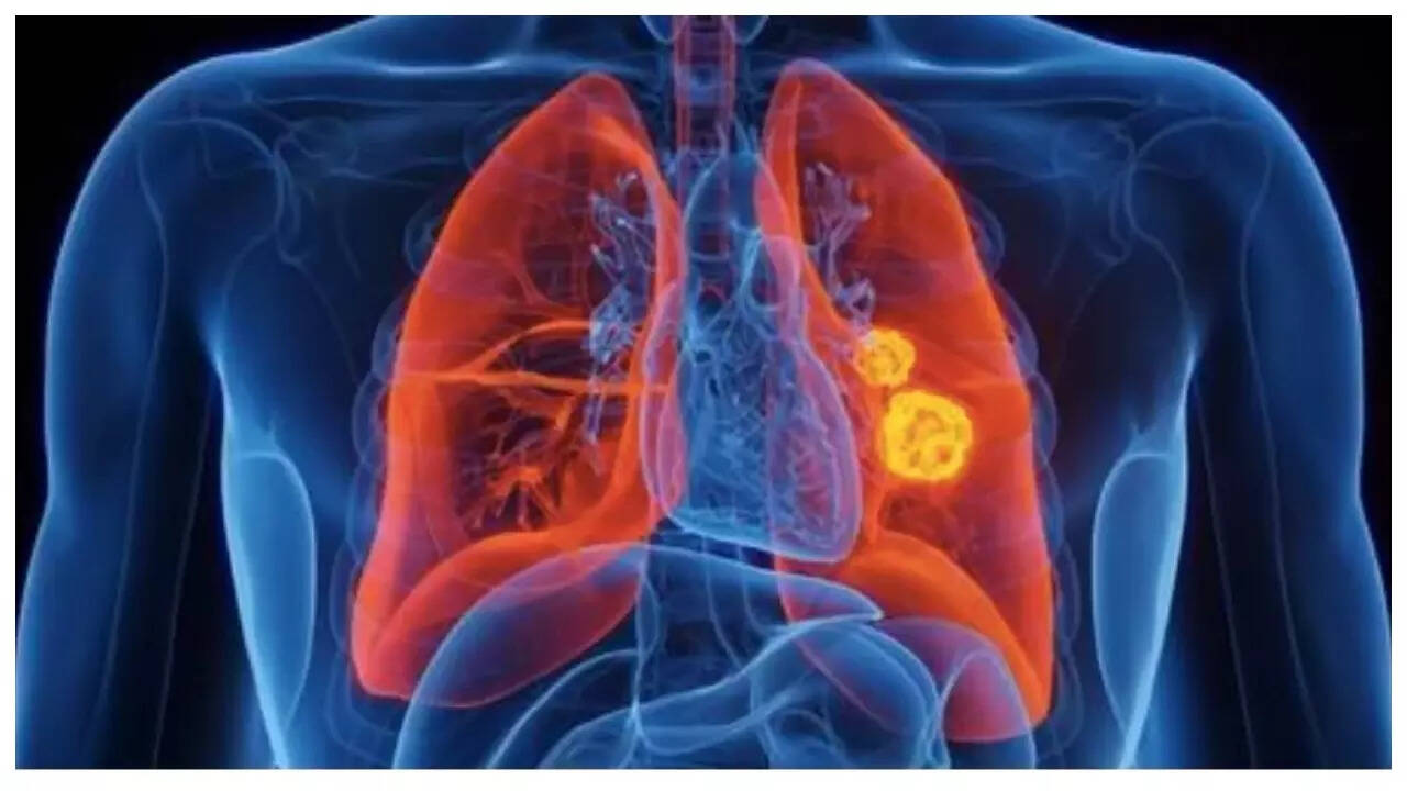 Lung Cancer rising in young adults - causes, symptoms, prevention and ...