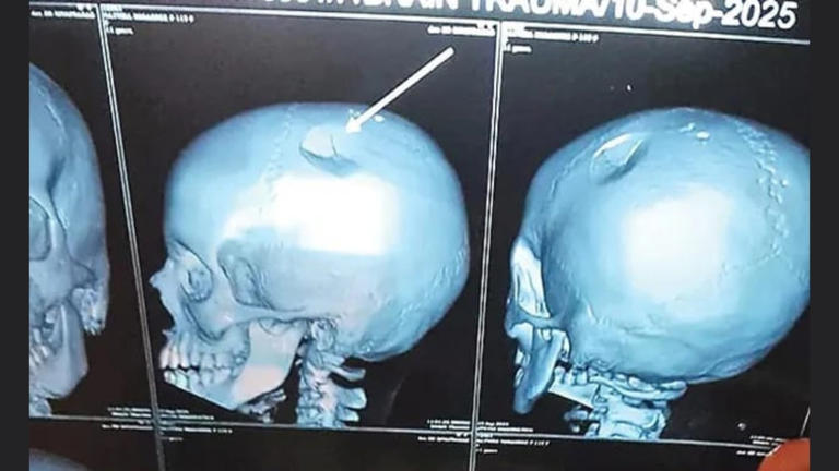 Andhra Class 6 girl suffers skull fracture after teacher hits her with ...