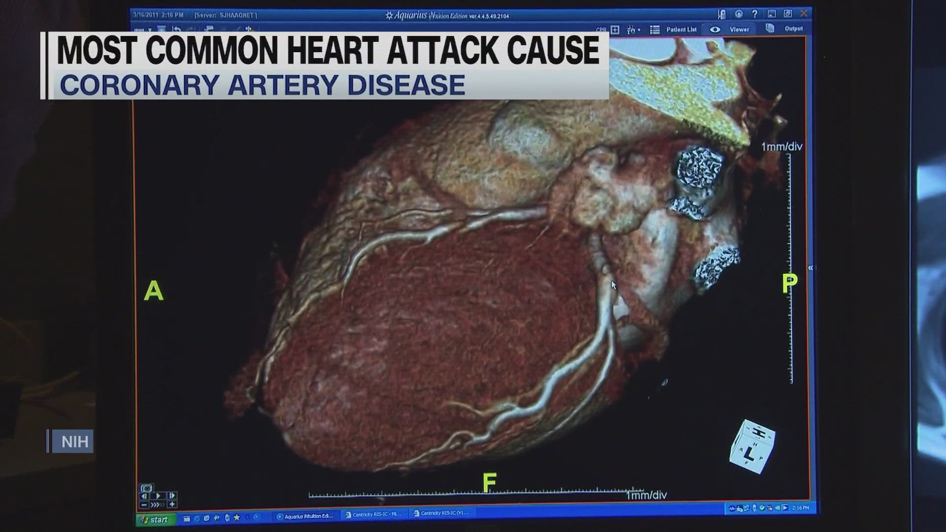 New study reveals some hidden causes of heart attacks in adults under 65