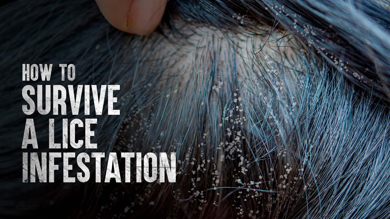 Lice infestation survival tips