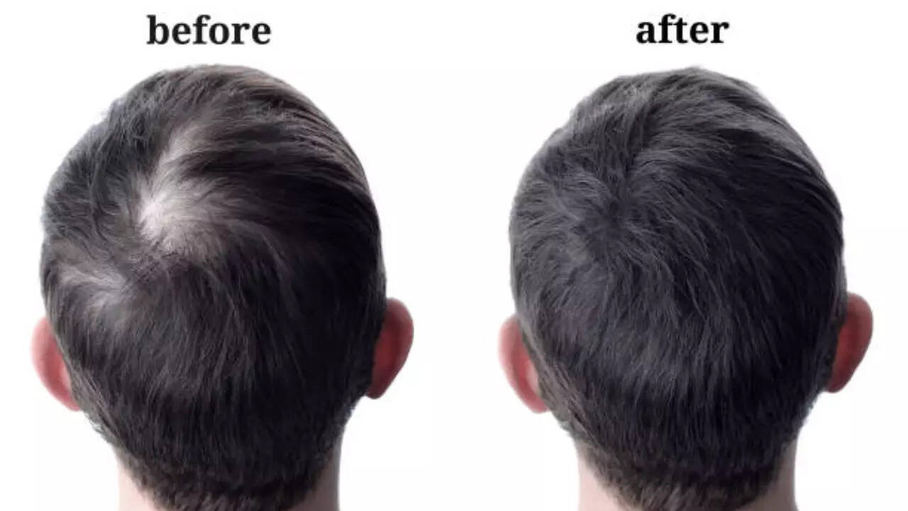 Bald Genes in family? Try these 5 foods to prevent hair loss