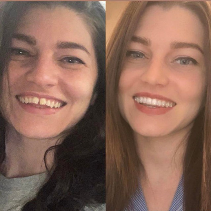 15 People Who Chose Plastic Surgery and Are Totally Obsessed with Their ...