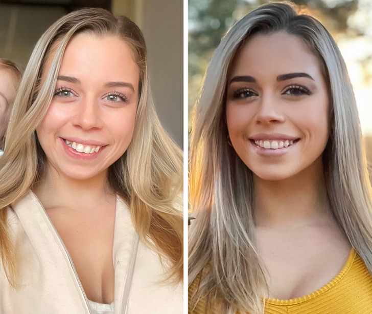 15 People Who Chose Plastic Surgery and Are Totally Obsessed with Their ...