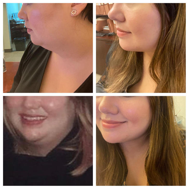 15 People Who Chose Plastic Surgery and Are Totally Obsessed with Their ...
