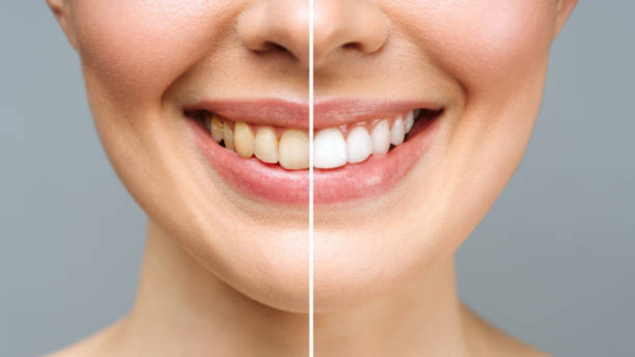 How to whiten teeth naturally (without spending a fortune)