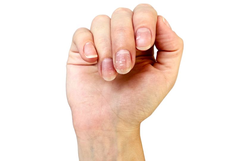 Health warning signs on your nails to watch for - white spots, vertical ...