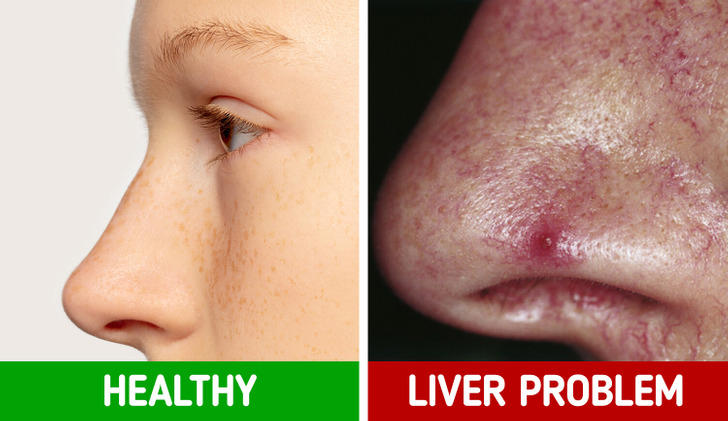 6 Unusual Warning Signs of Liver Issues You Shouldn’t Ignore