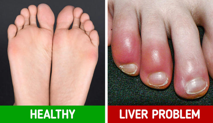 6 Unusual Warning Signs of Liver Issues You Shouldn’t Ignore