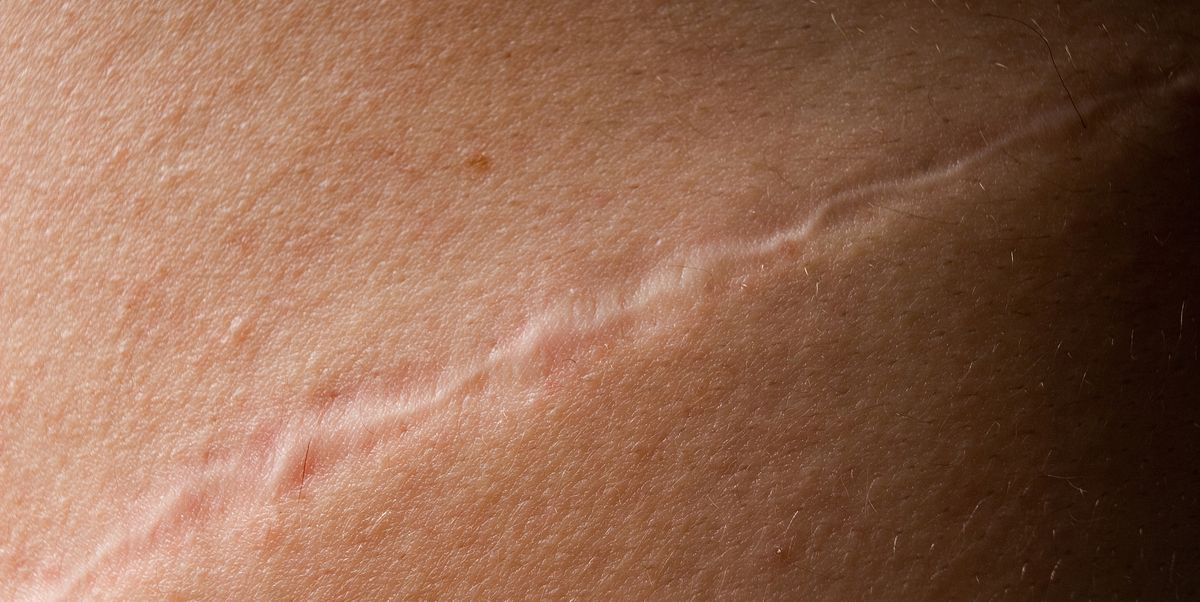 Scientists May Have Found a Way to Get Rid of Your Scars