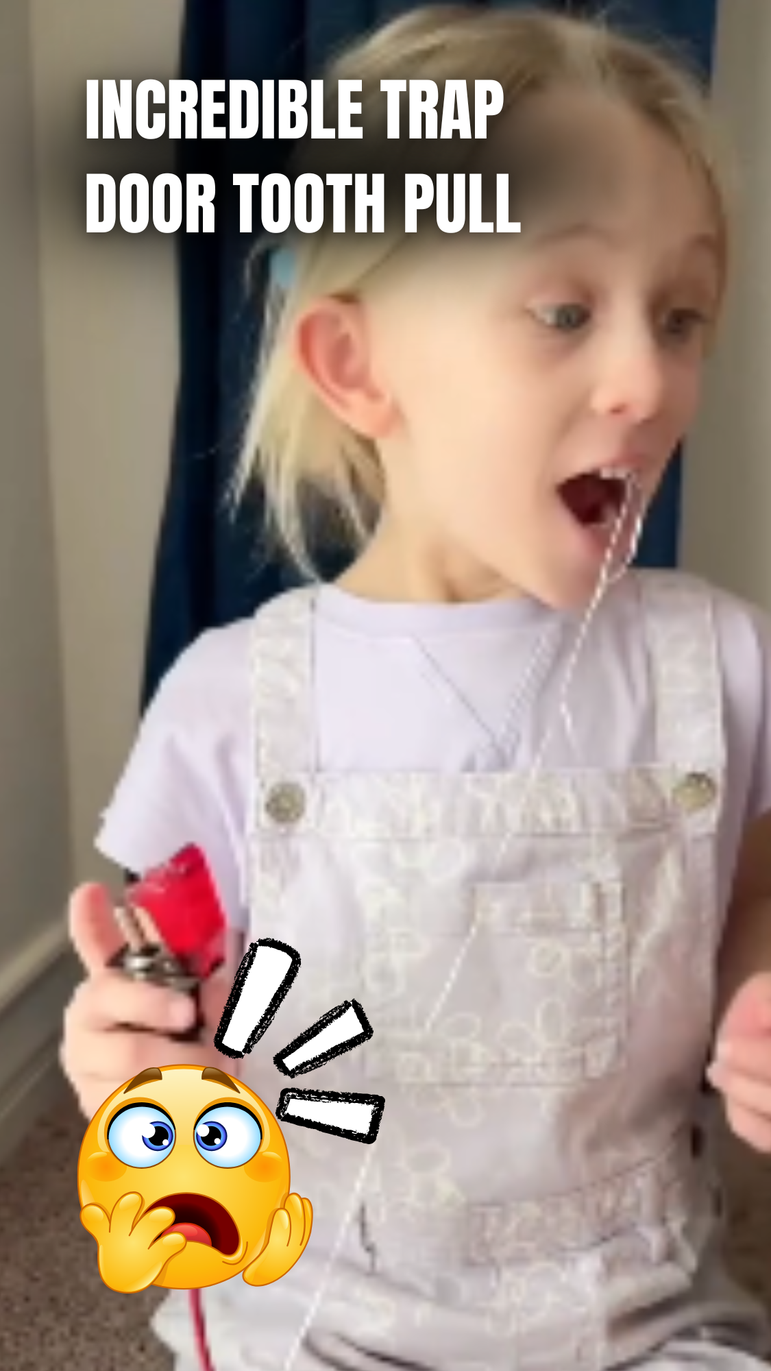 Watch This Incredible Trap Door Tooth Pull In Action