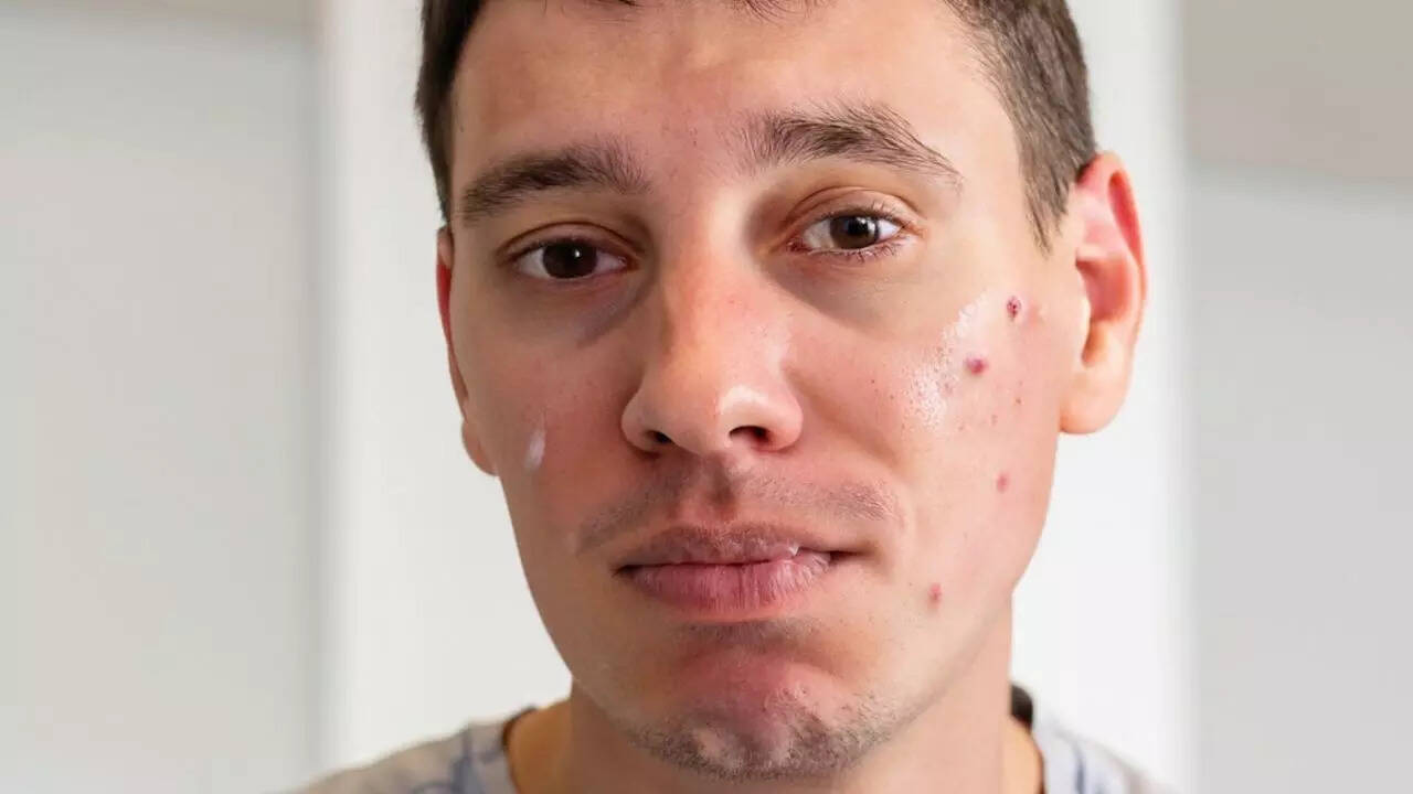 Common men’s skin problems: Causes, prevention, and skincare tips