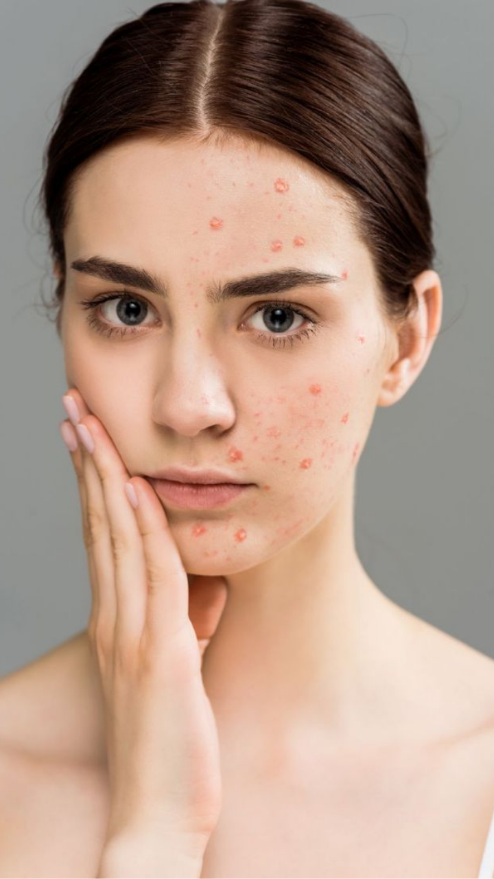Acne map: 8 face areas most prone to acne
