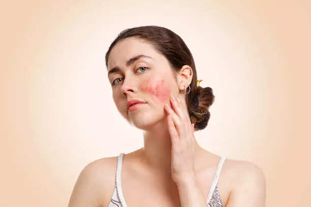 5 side effects of using Aloe Vera on skin