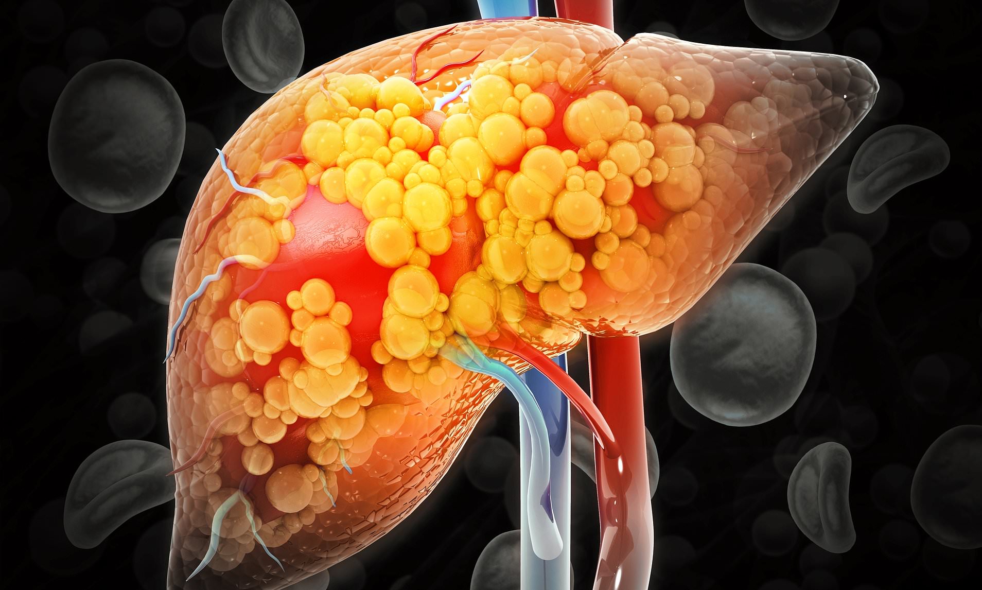 Scientists pinpoint three major risk factors of developing deadly liver ...