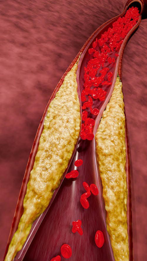 More Americans meet criteria for high blood pressure under new guidelines
