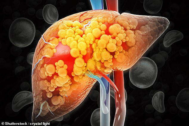 Scientists pinpoint three major risk factors of developing deadly liver ...