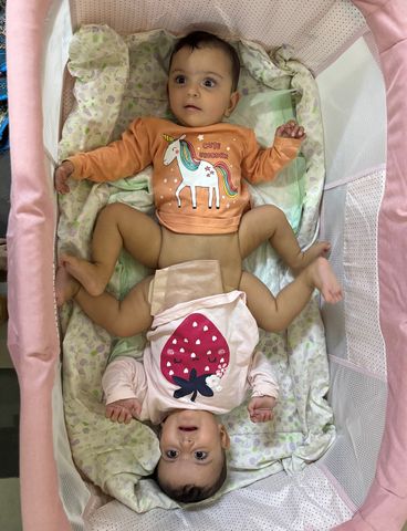 Rare Conjoined Twins Successfully Separated After 18-Hour Surgery That ...