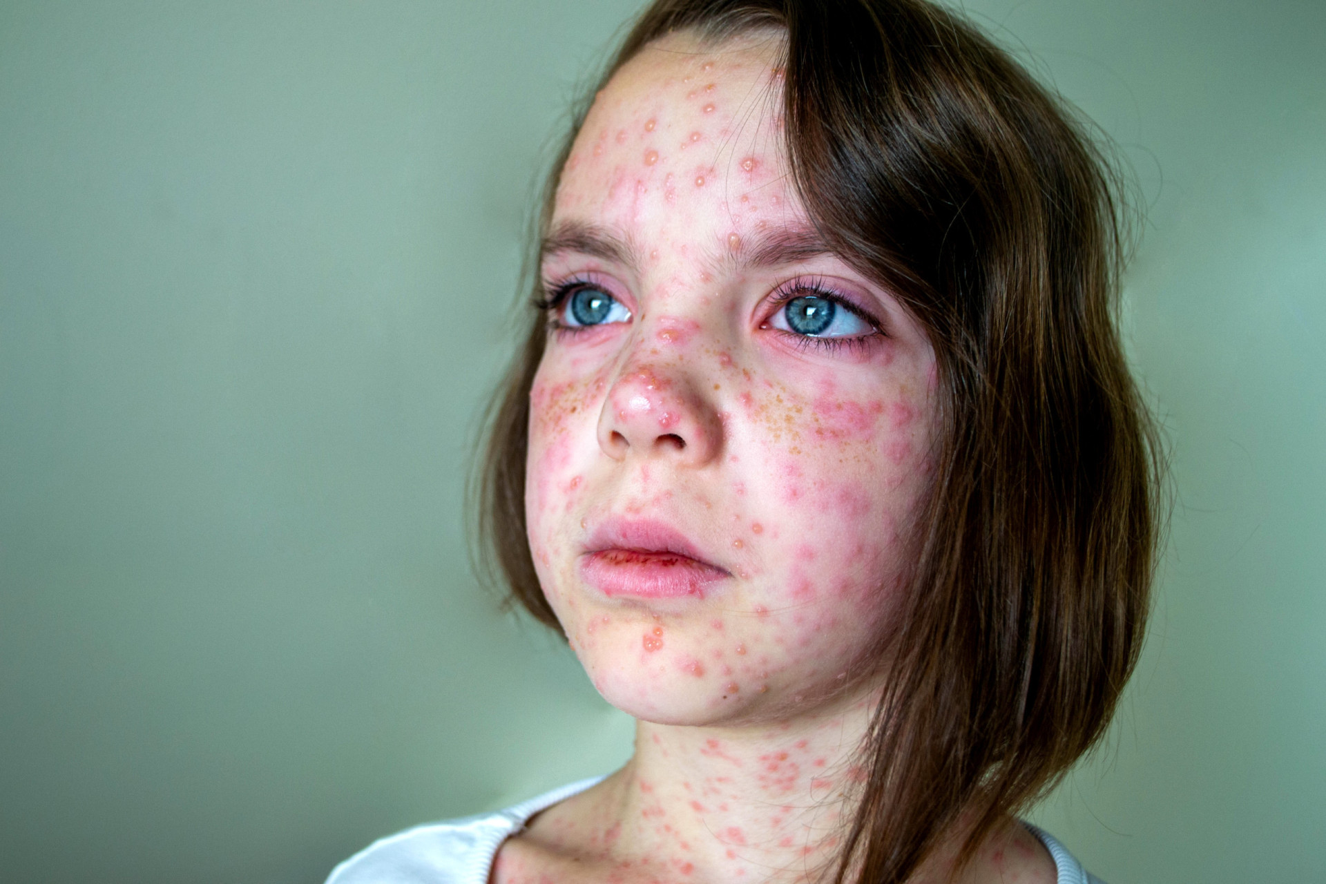 How dangerous is measles?