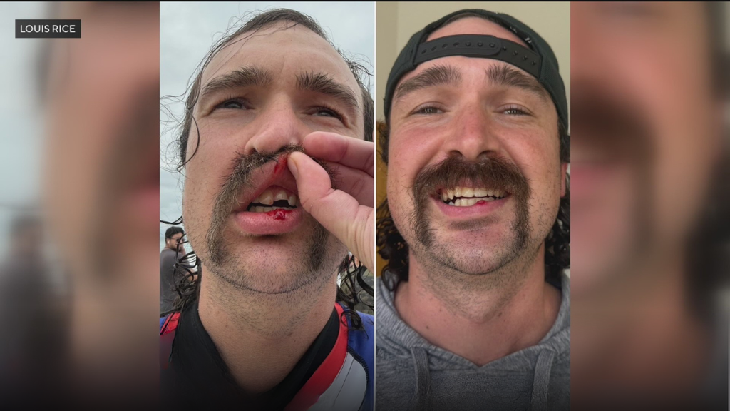 Huntington Beach dentist helps Marine veteran who broke tooth while surfing