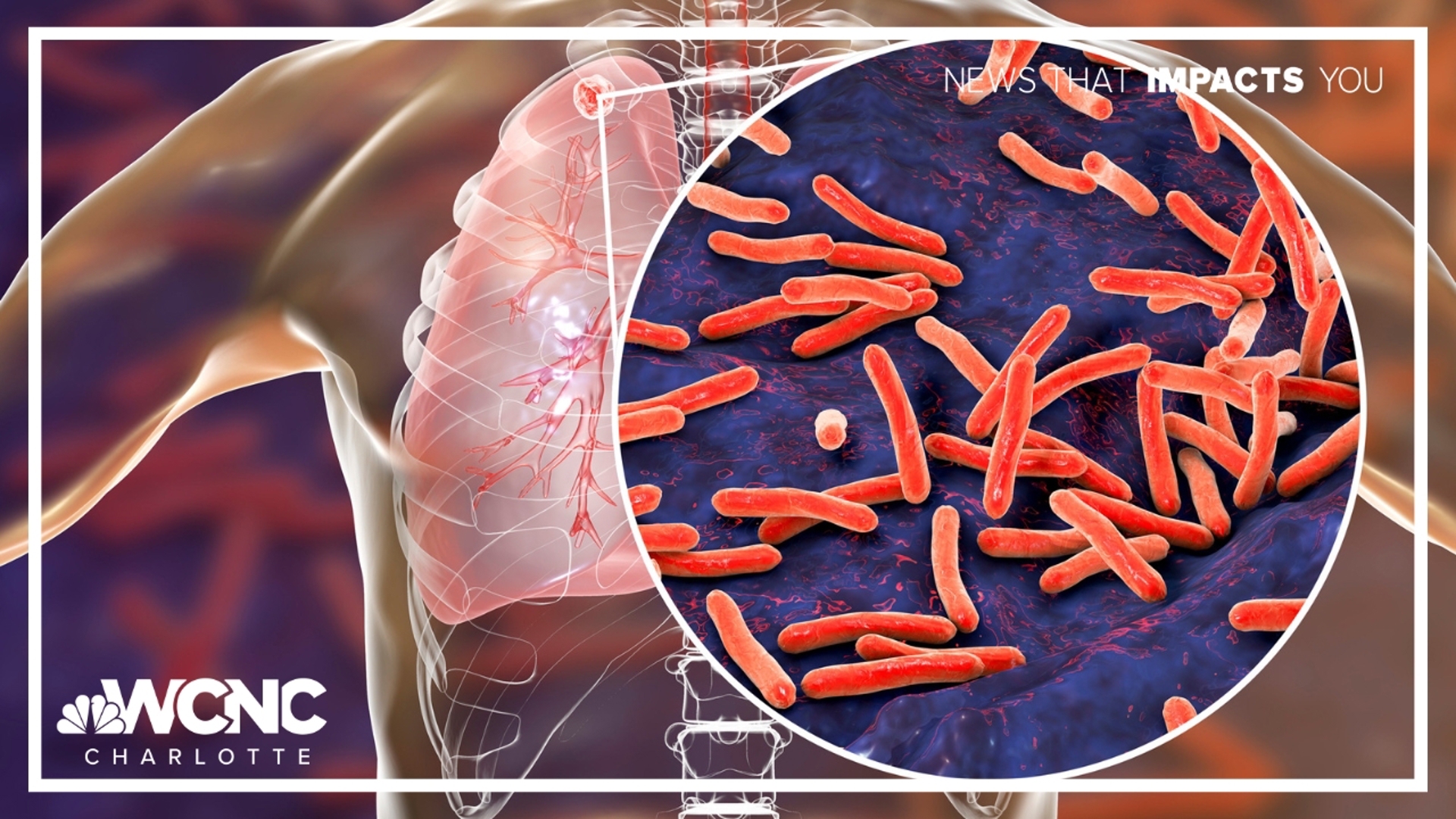 Positive tuberculosis case confirmed at East Lincoln High