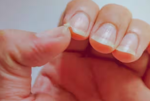 Nail Marks Symptoms: If you see these marks on your nails, then ...
