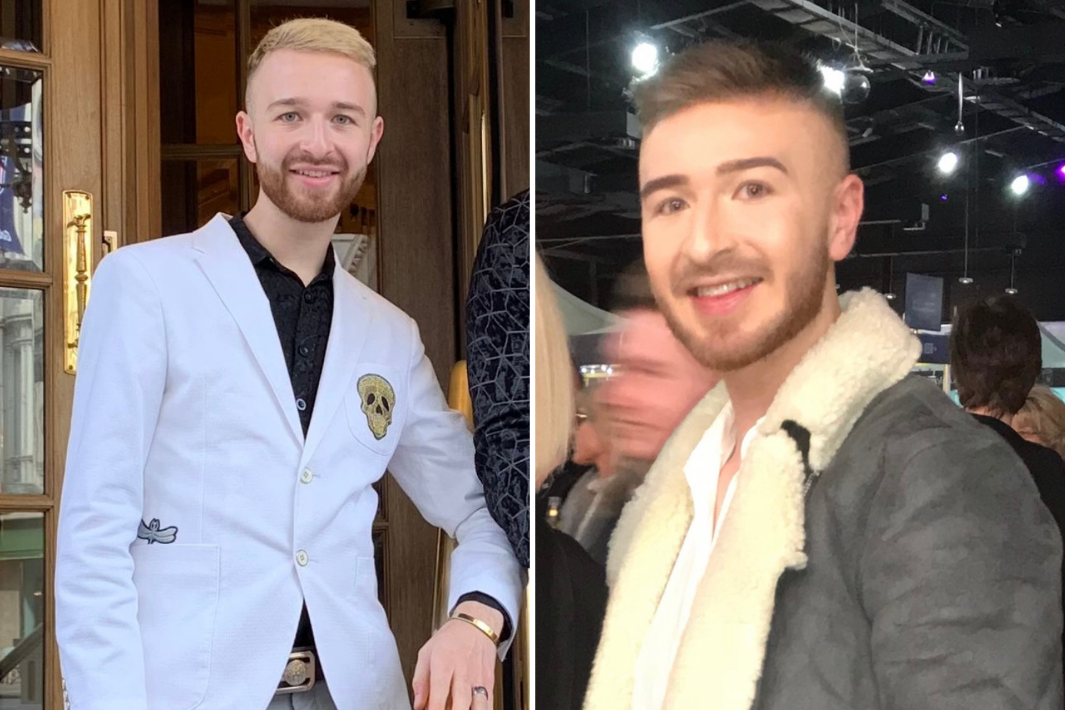 I was addicted to filler and spent $4k on injections—then I had realization