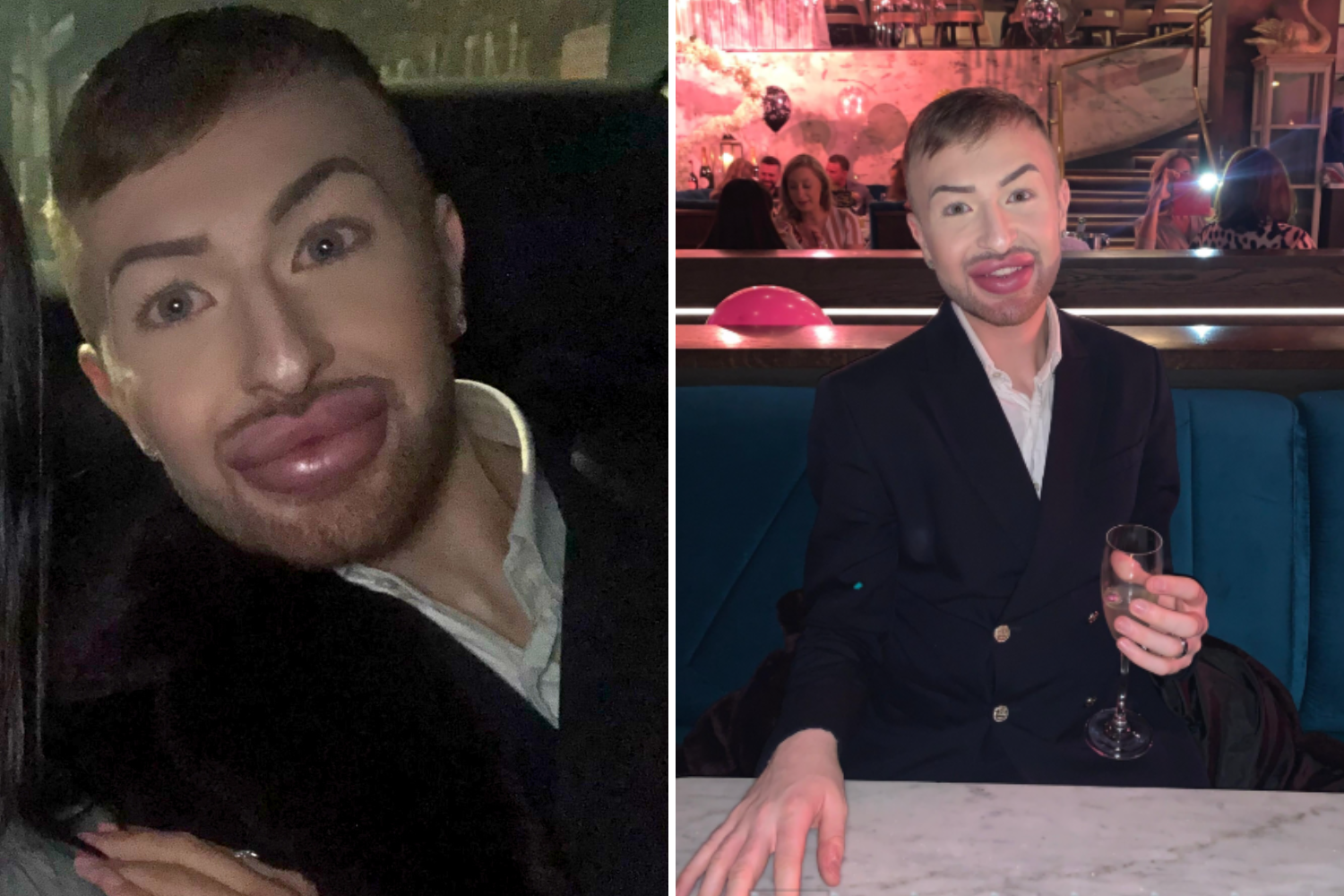 I was addicted to filler and spent $4k on injections—then I had realization