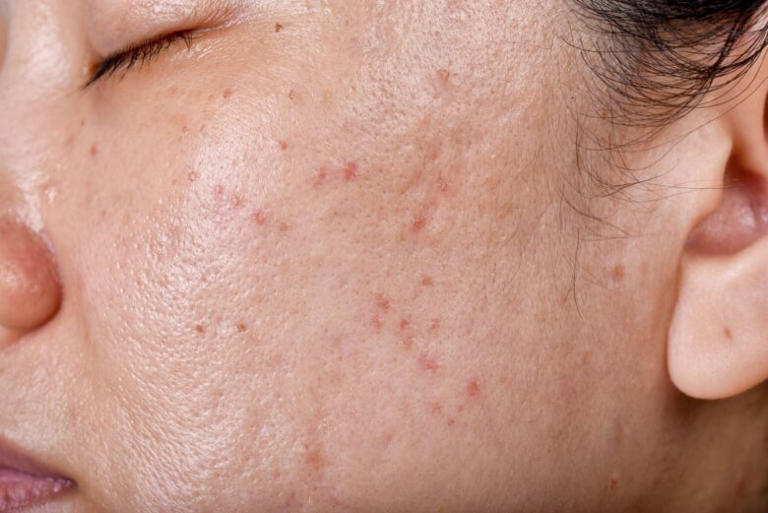 The strongest acne medications: Finding the right fit for you