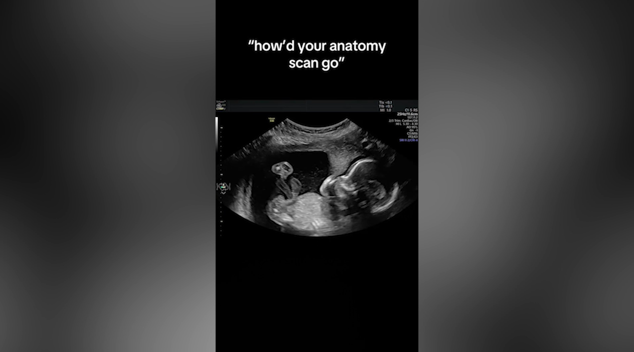 Pregnant Woman Asked How 20 Week Anatomy Scan Went, Video Says It All