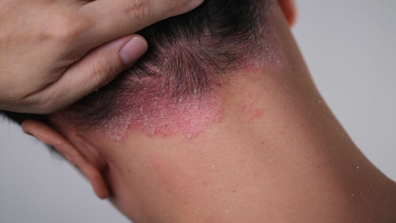 How to stop your dry scalp from causing hair loss