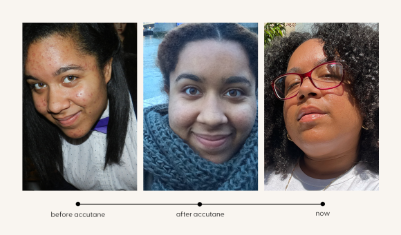 Before & After: What 10 Years of Accutane Did for Me