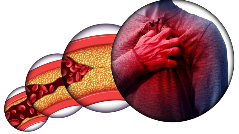 5 apparent signs of high cholesterol in young people