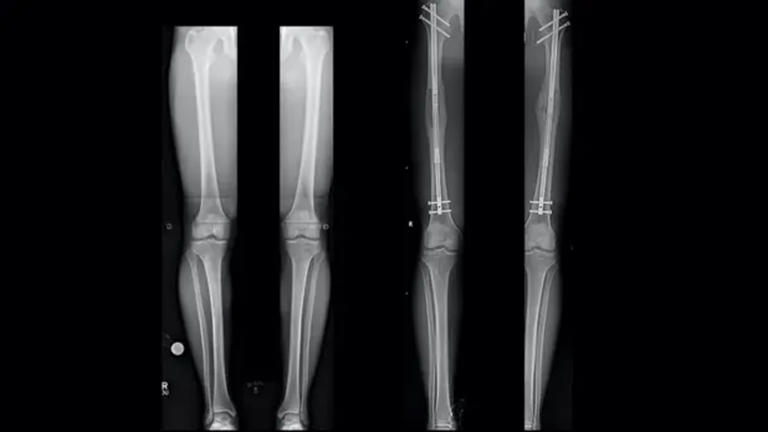 Would You Break Your Legs to Stand Taller? Exploring The Leg ...