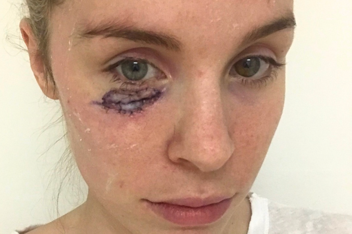 ‘A spot under my eye turned out to be skin cancer aged just 26, now i ...