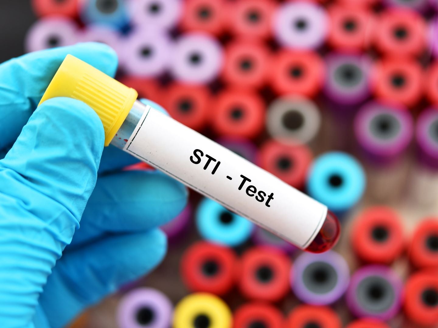 US hospital STI testing sales drop amid “multifactorial” causes