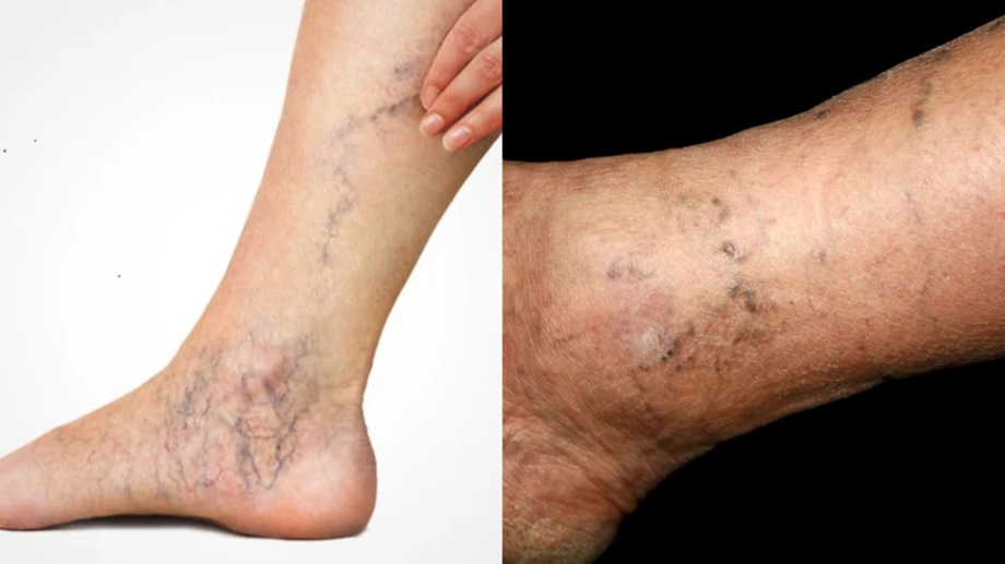 Health: 6 symptoms of blocked arteries are seen in the legs, ignoring ...