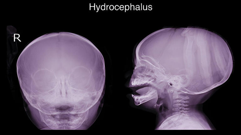 Hydrocephalus: Understanding The Dangers Of 'Water On The Brain' Across ...