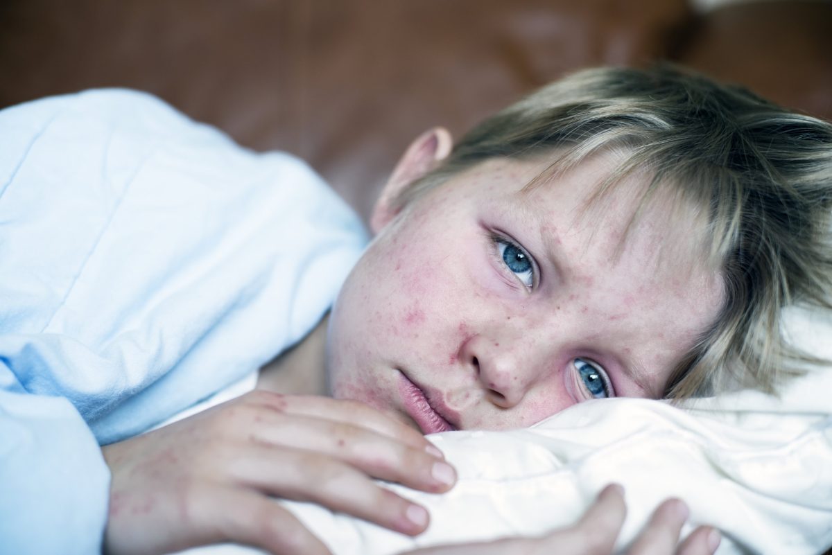Measles cases set to spike in weeks after school return, scientists warn