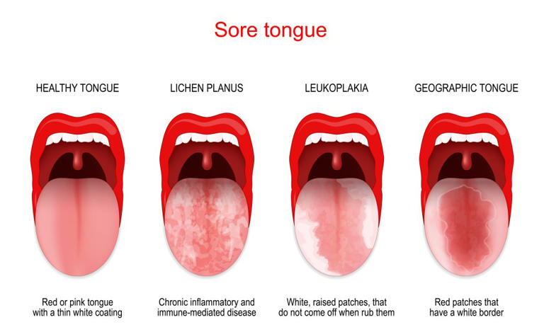What is ‘geographic tongue’? All about ‘SNL’ star Kate McKinnon’s ...