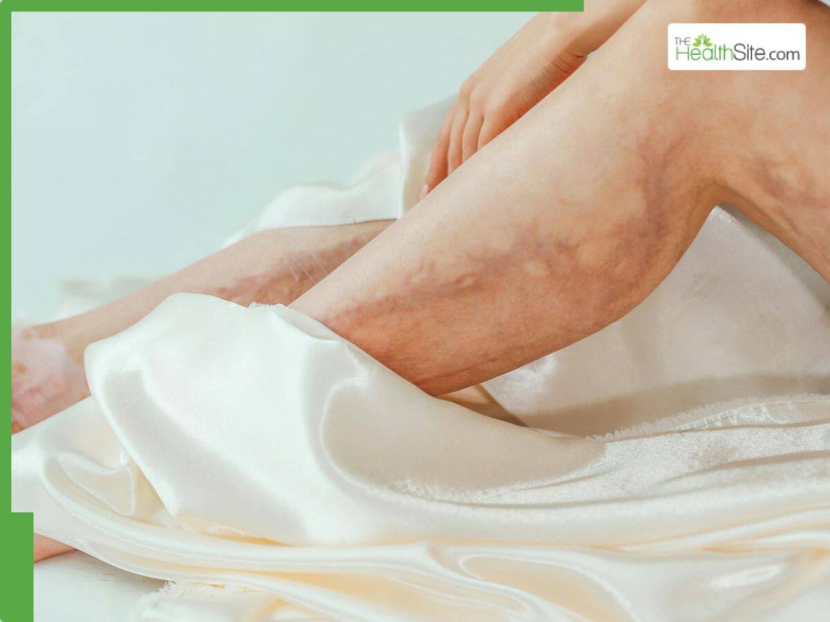 Peripheral Artery Disease: 6 Warning Signs Of Blocked Arteries That ...