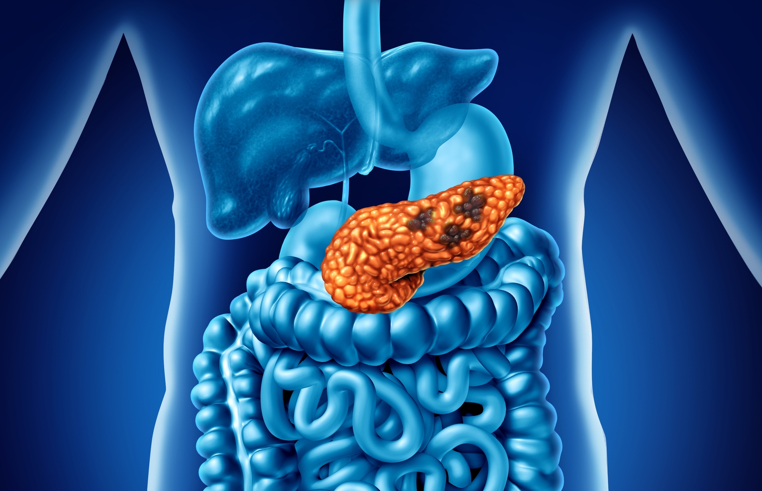 Immuneering surges 40% on mid-stage atebimetinib data in pancreatic cancer